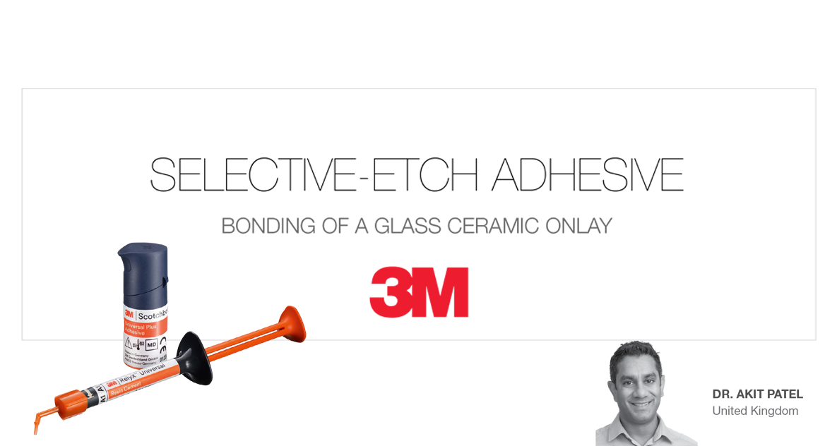 Selective-etch Adhesive Bonding of A Glass Ceramic Onlay - Henry Schein ...