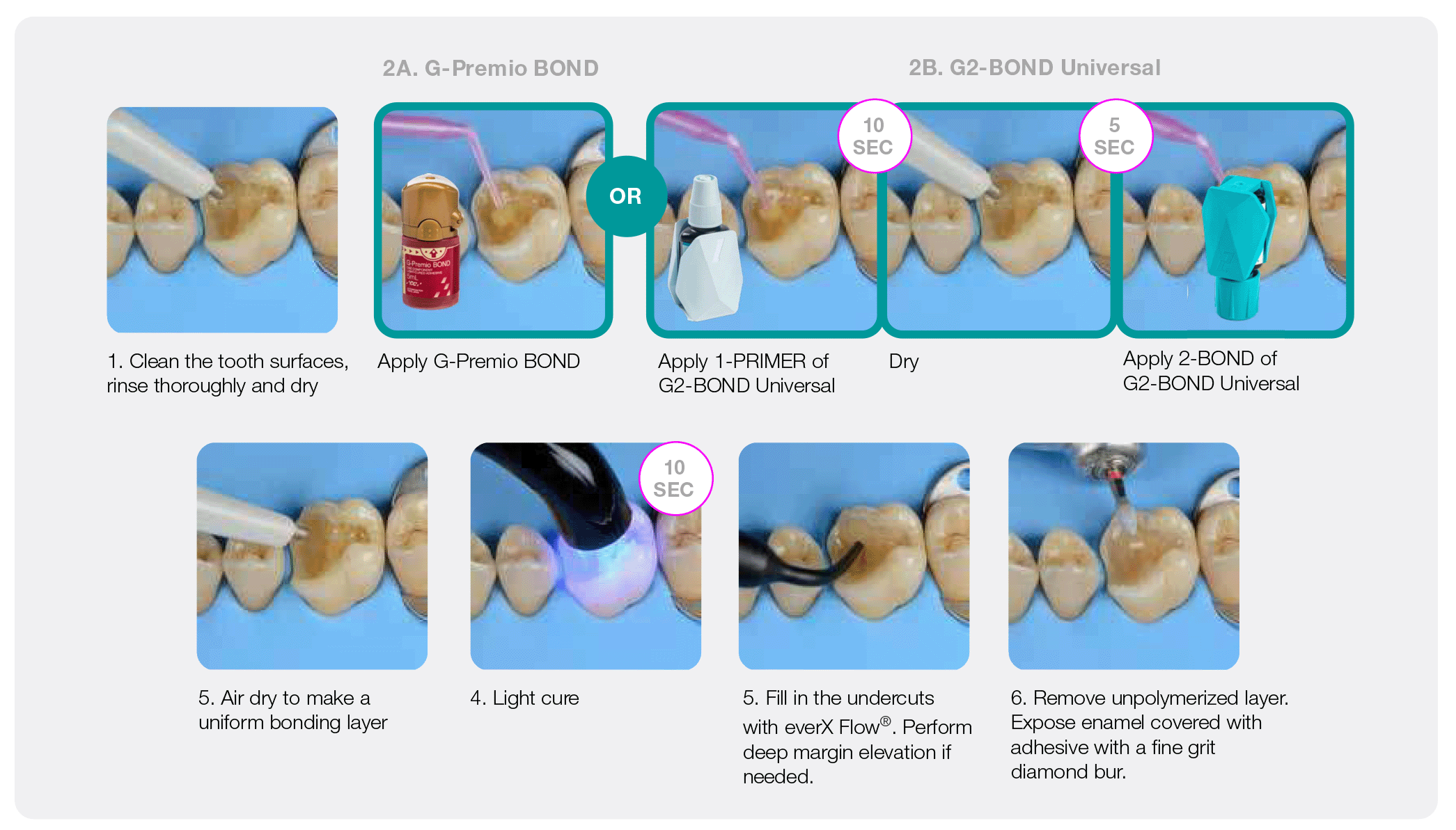 Why immediate dentine sealing - Henry Schein New Zealand