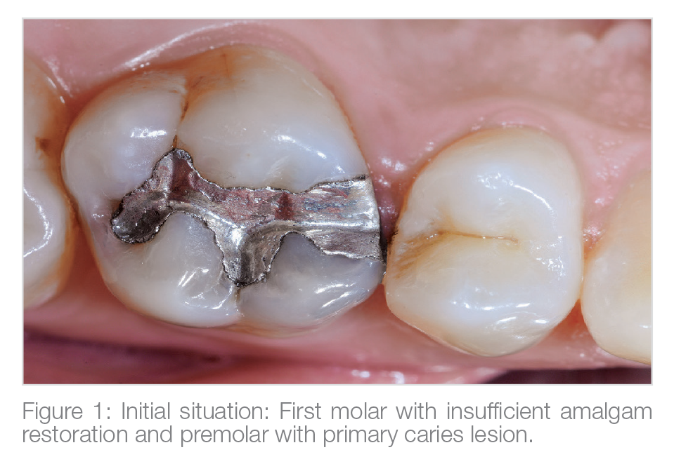 Amalgam Replacement - Henry Schein New Zealand
