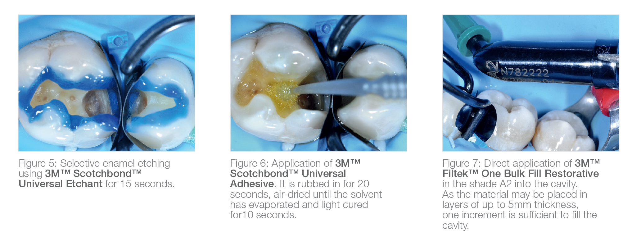 Amalgam Replacement - Henry Schein New Zealand
