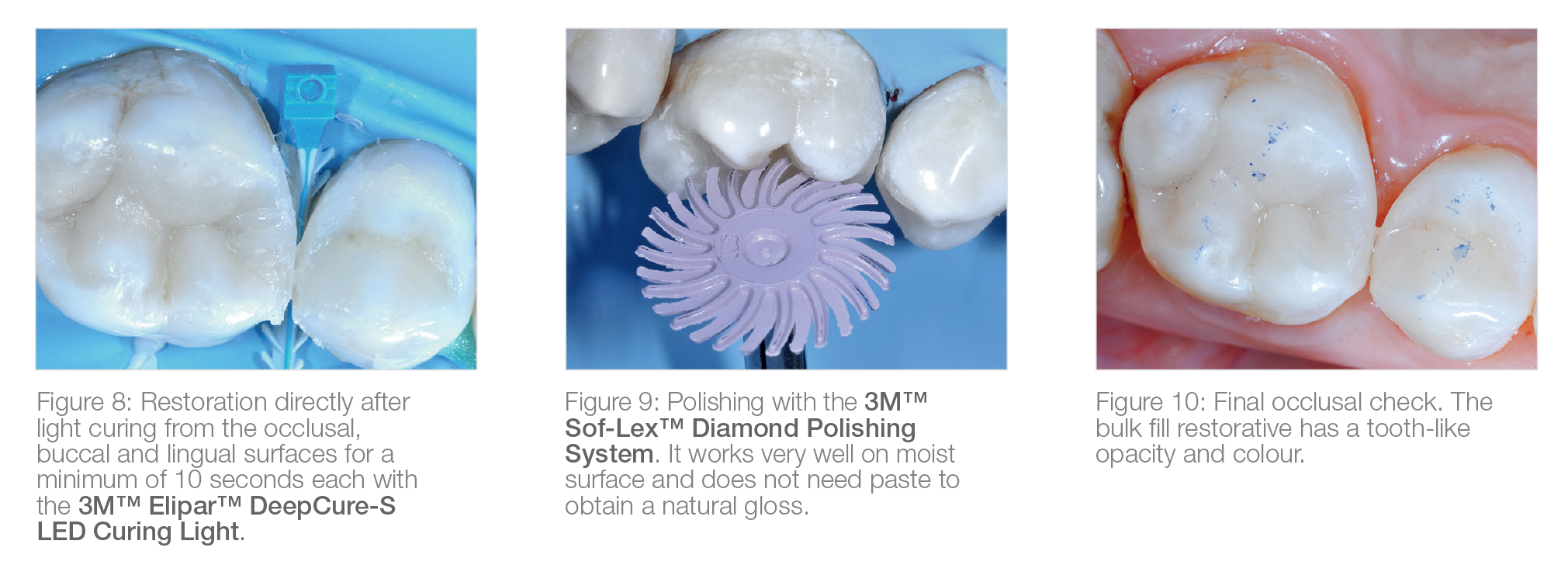 Amalgam Replacement - Henry Schein New Zealand