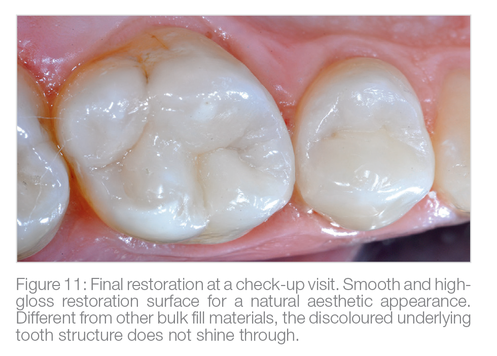 Amalgam Replacement - Henry Schein New Zealand