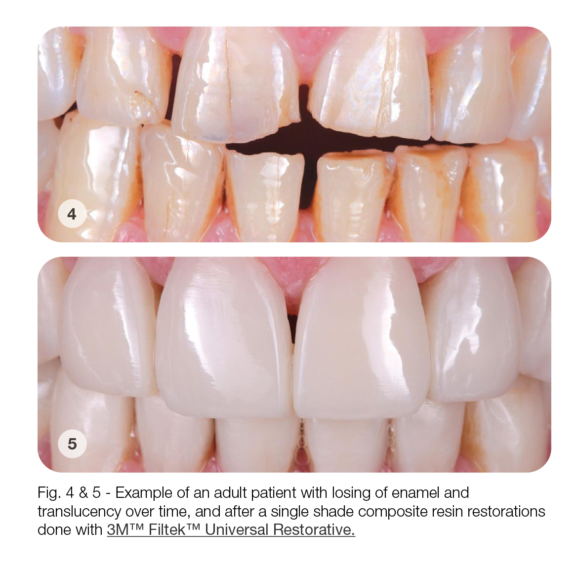 Choosing Composite Shades in Restorative Dentistry: A Practical Guide ...