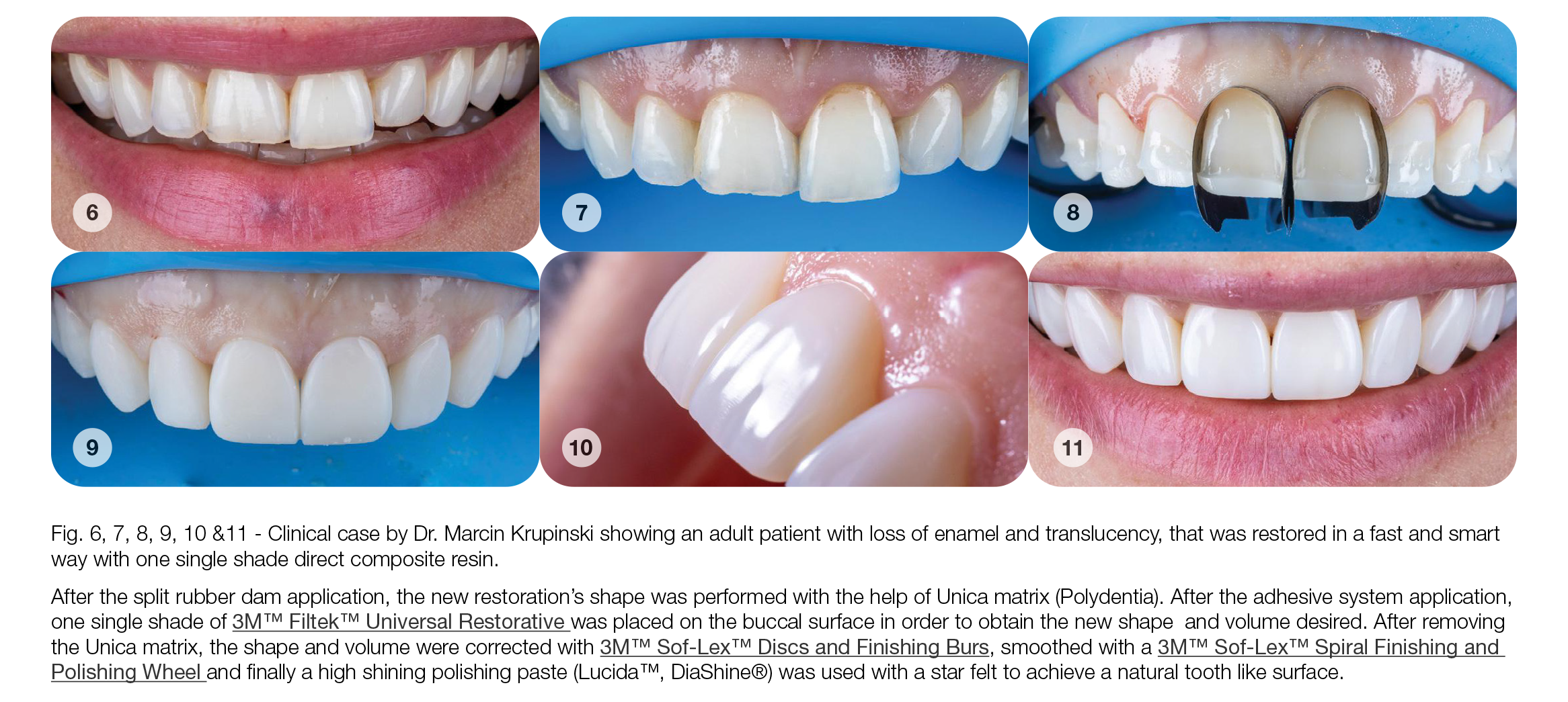 Choosing Composite Shades in Restorative Dentistry: A Practical Guide ...