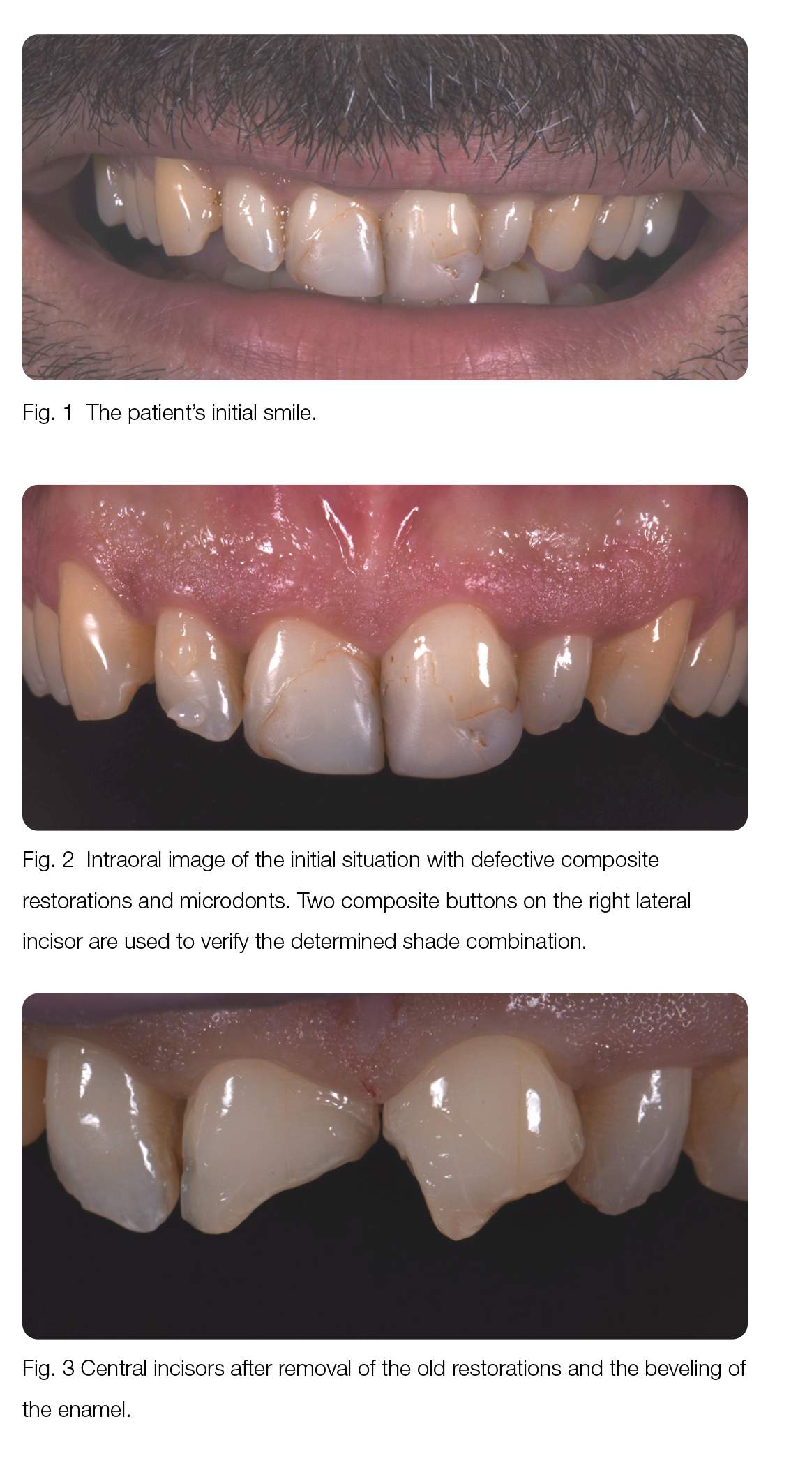 Composite Restorations in the Anterior Region - Henry Schein New Zealand