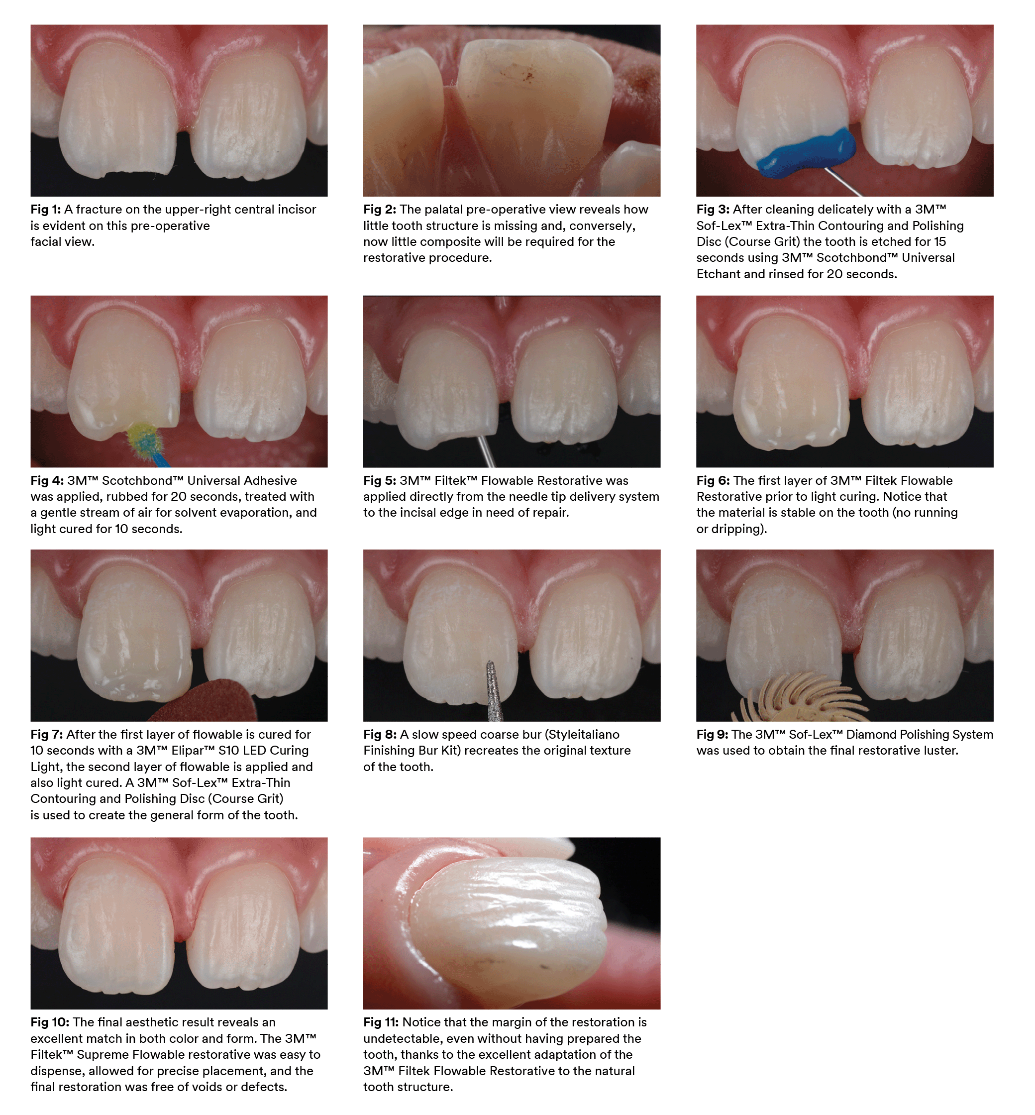 Marginal Enamel Chipping - Henry Schein New Zealand