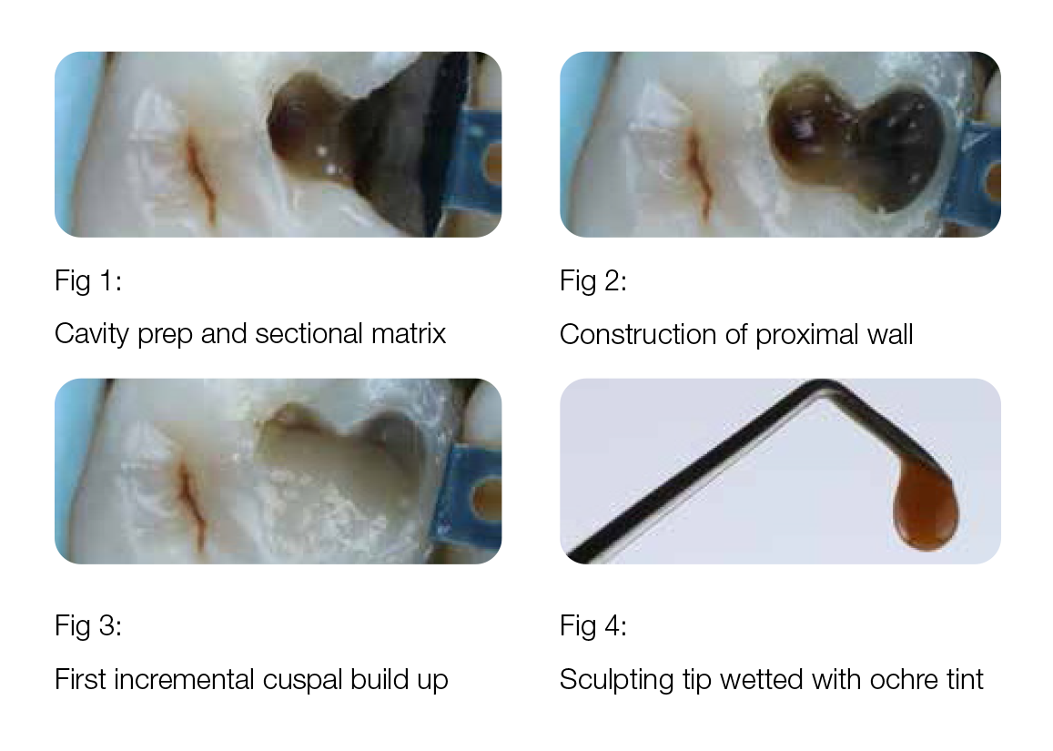 Effective Solution For A Defective Amalgam Restoration - Henry Schein ...