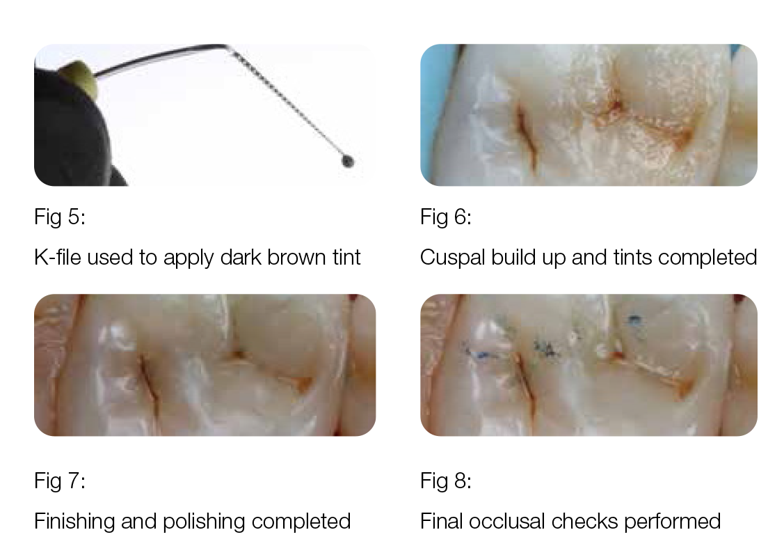 Effective Solution For A Defective Amalgam Restoration - Henry Schein ...