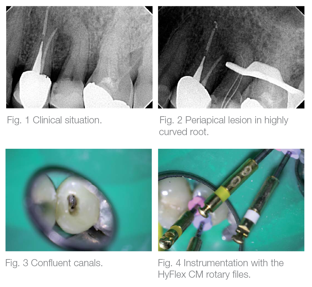 Pressing Endodontic Issues - Henry Schein New Zealand
