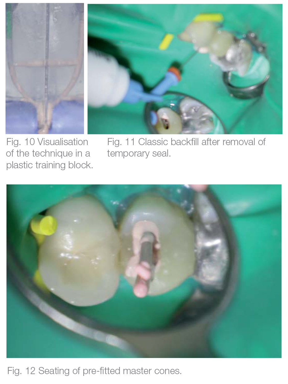 Pressing Endodontic Issues - Henry Schein New Zealand