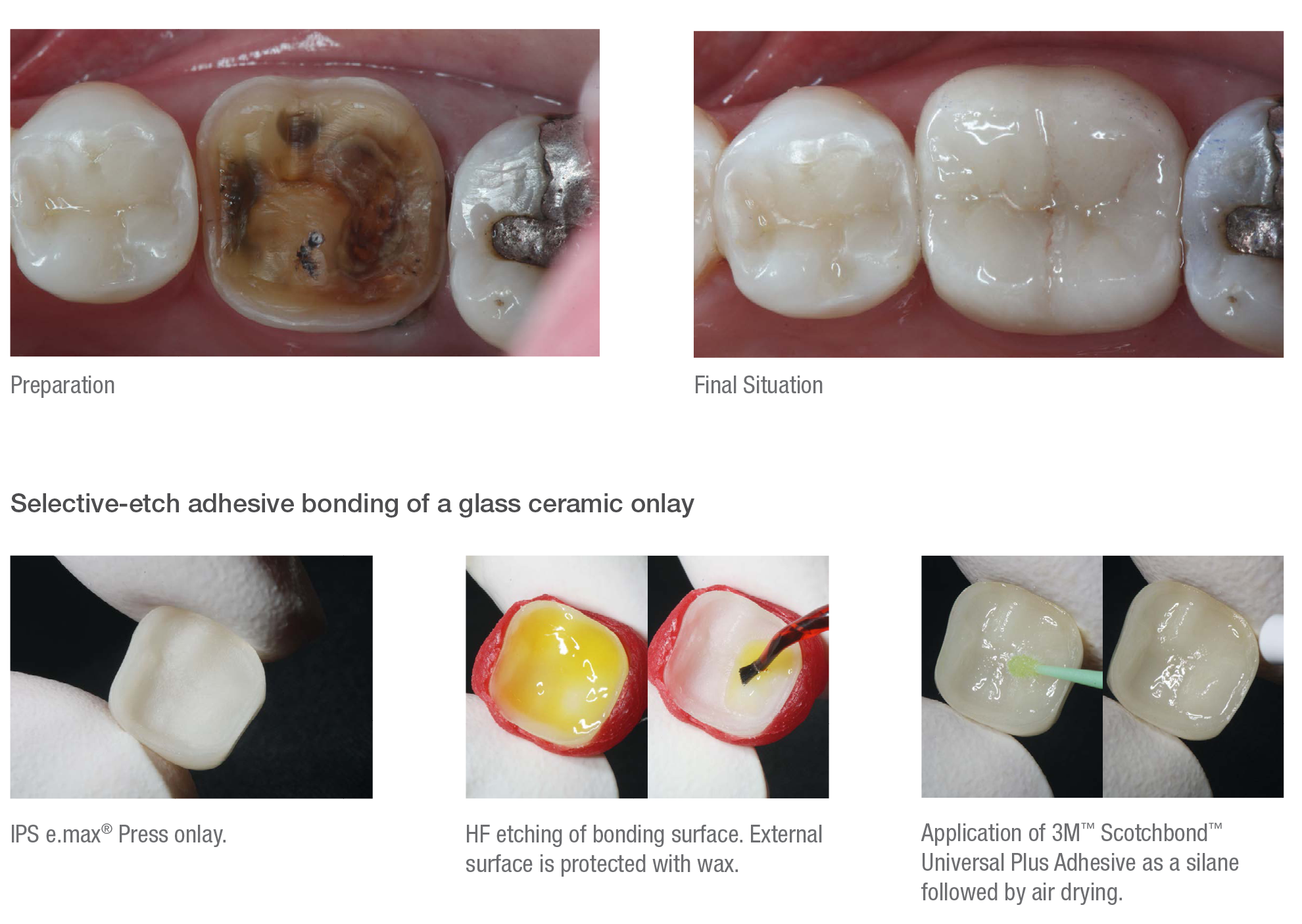 Selective-etch Adhesive Bonding of A Glass Ceramic Onlay - Henry Schein ...