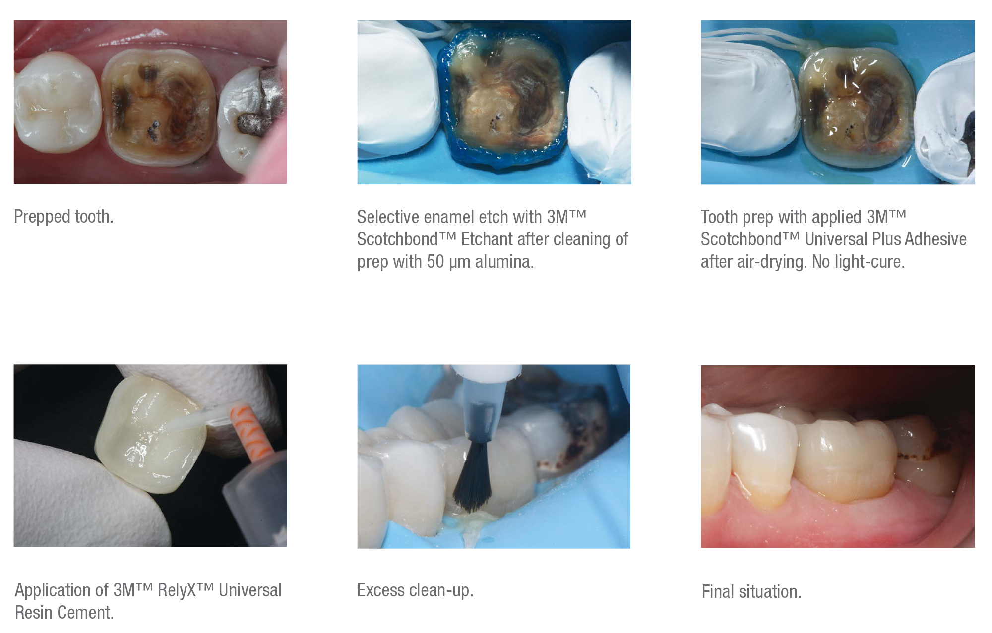 Selective-etch Adhesive Bonding of A Glass Ceramic Onlay - Henry Schein ...