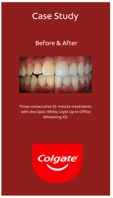 Tooth Whitening - Henry Schein New Zealand